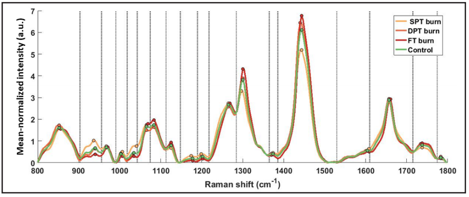 RS-OCT: Bimodal Diagnostic System for Classification of Burn Injuries ...
